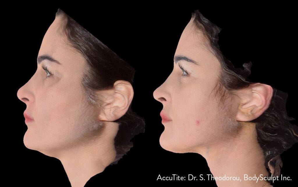 AccuTite Upper East Side - Facial Contouring NYC